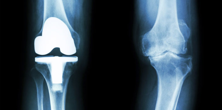 Kniegelenkimplantation/Knie-TEP – ProPatient24