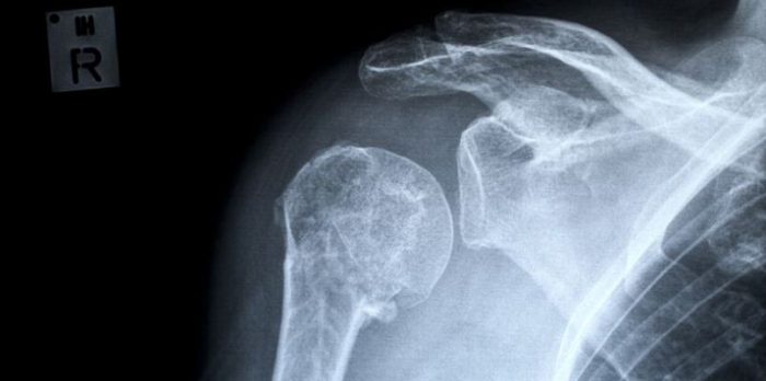 Verrenkung (Luxation) – ProPatient24